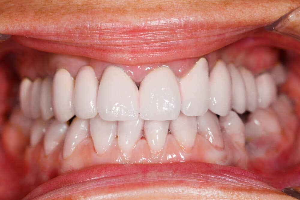 Virtual Smile Assessment | Cherry Orthodontics | Bethlehem ...